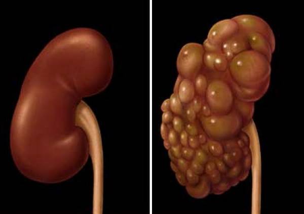 Tămâia topește chisturi de pe ficat, plămâni, rinichi, ovare